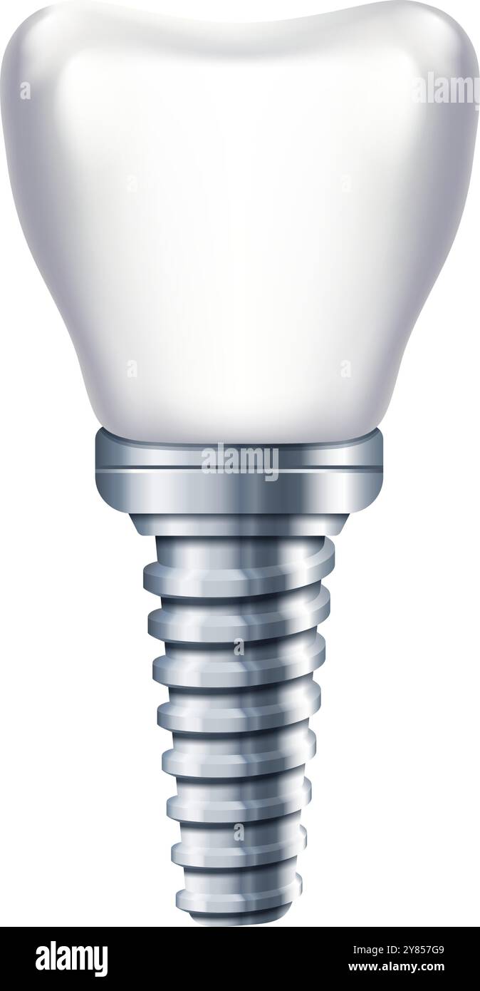 Tooth implant. Dental prosthesis. Stomatology medical illustration ...