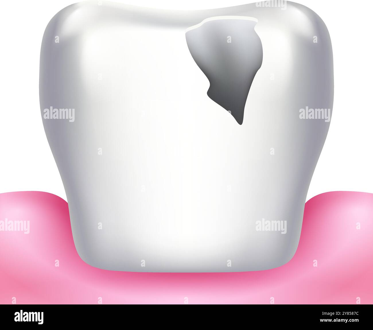 Broken tooth with hole in enamel. Dental treatment illustration Stock ...