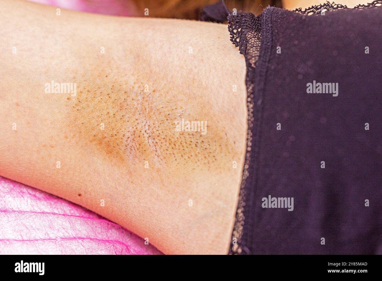 laser hair removal under the armpits of girls and women in a beauty ...