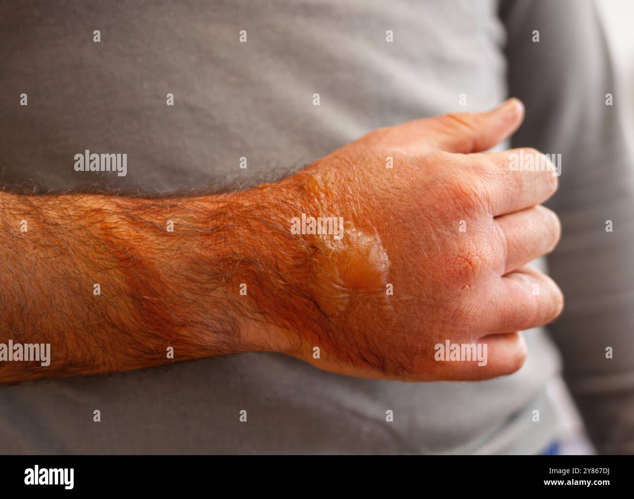 Construction worker showing a large second degree burn with blisters on ...