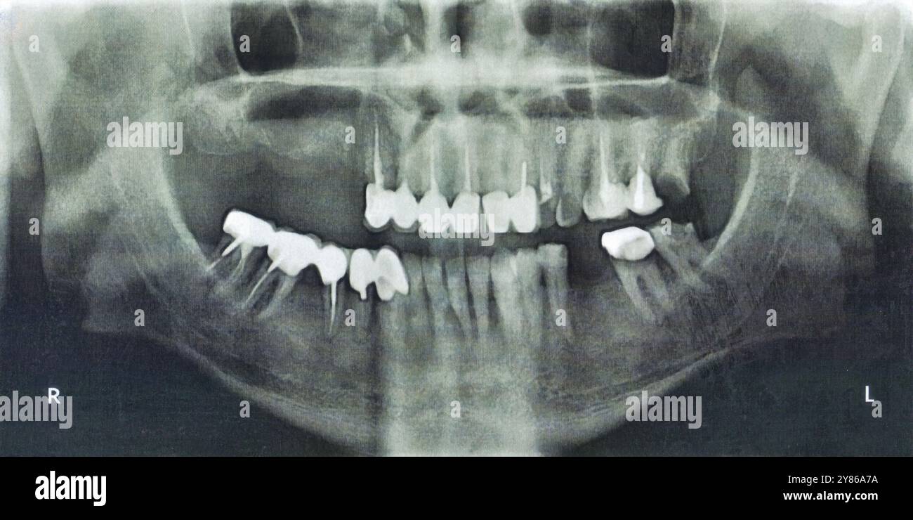 panoramic radiography teeth , x-ray data for the dentist Stock Photo ...