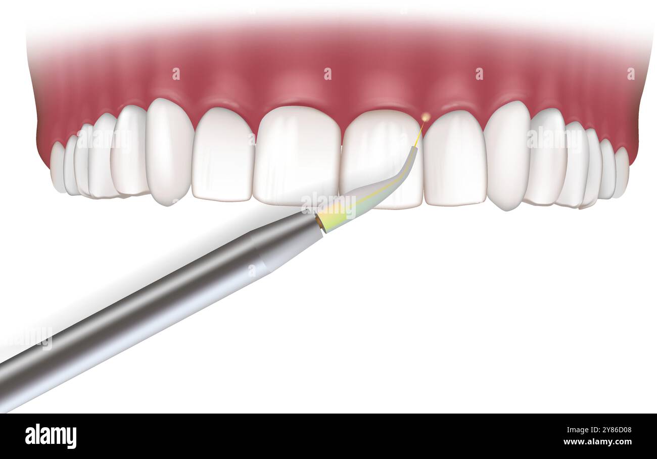 Dental laser with healthy white teeth. Laser dentistry instrument Stock ...