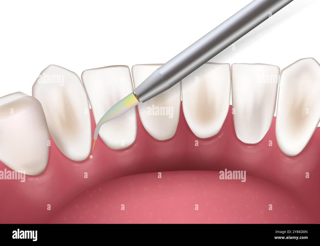 Dental laser with healthy white teeth. Laser dentistry instrument Stock ...