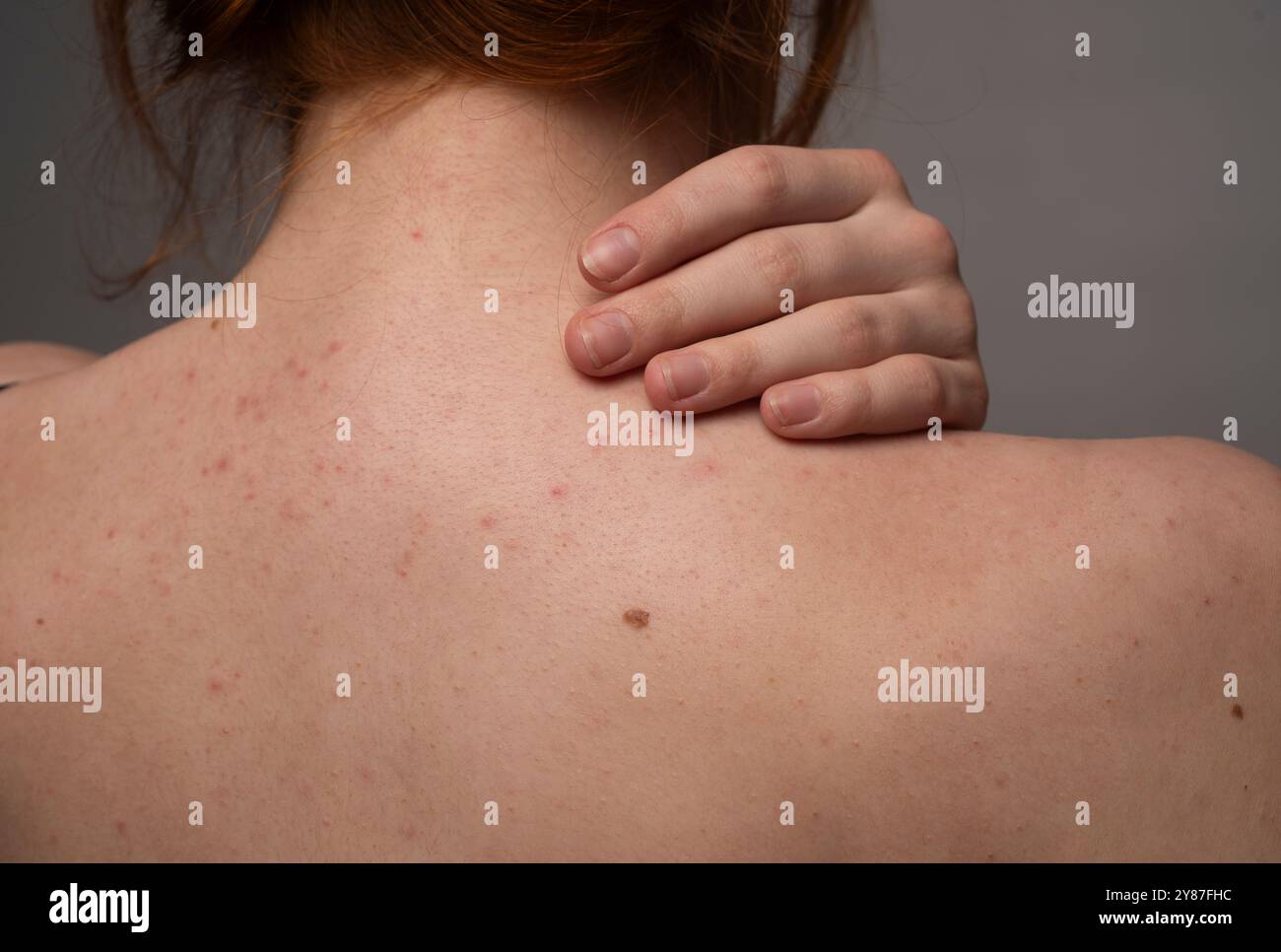Skin acne background. Acne problem on back. Dermatology and cosmetology ...