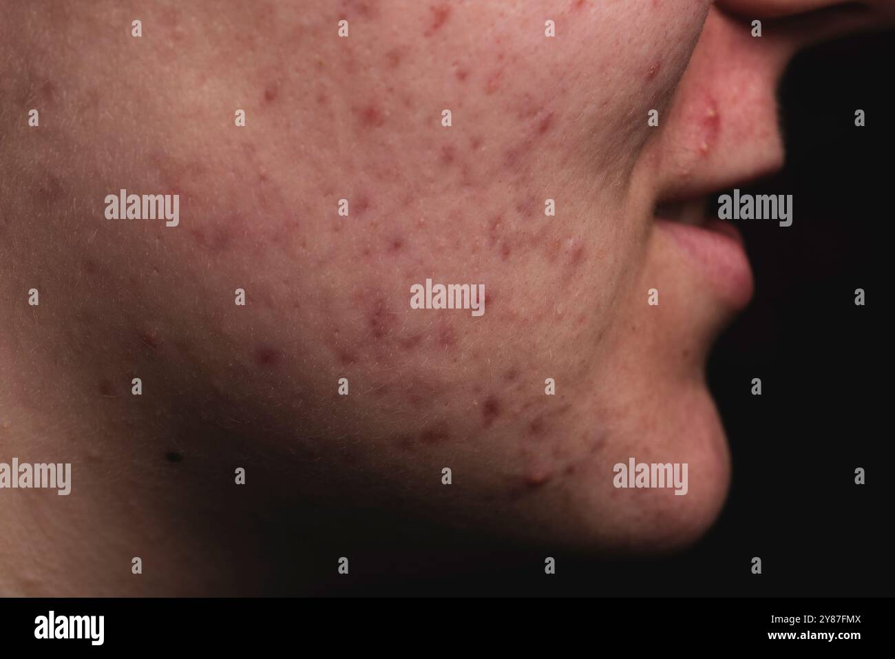 Skincare. Acne treatment. Face, skin, pimples. Girl with pimples ...