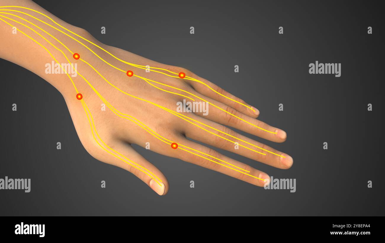 Numbness tingling in hand hi-res stock photography and images - Alamy