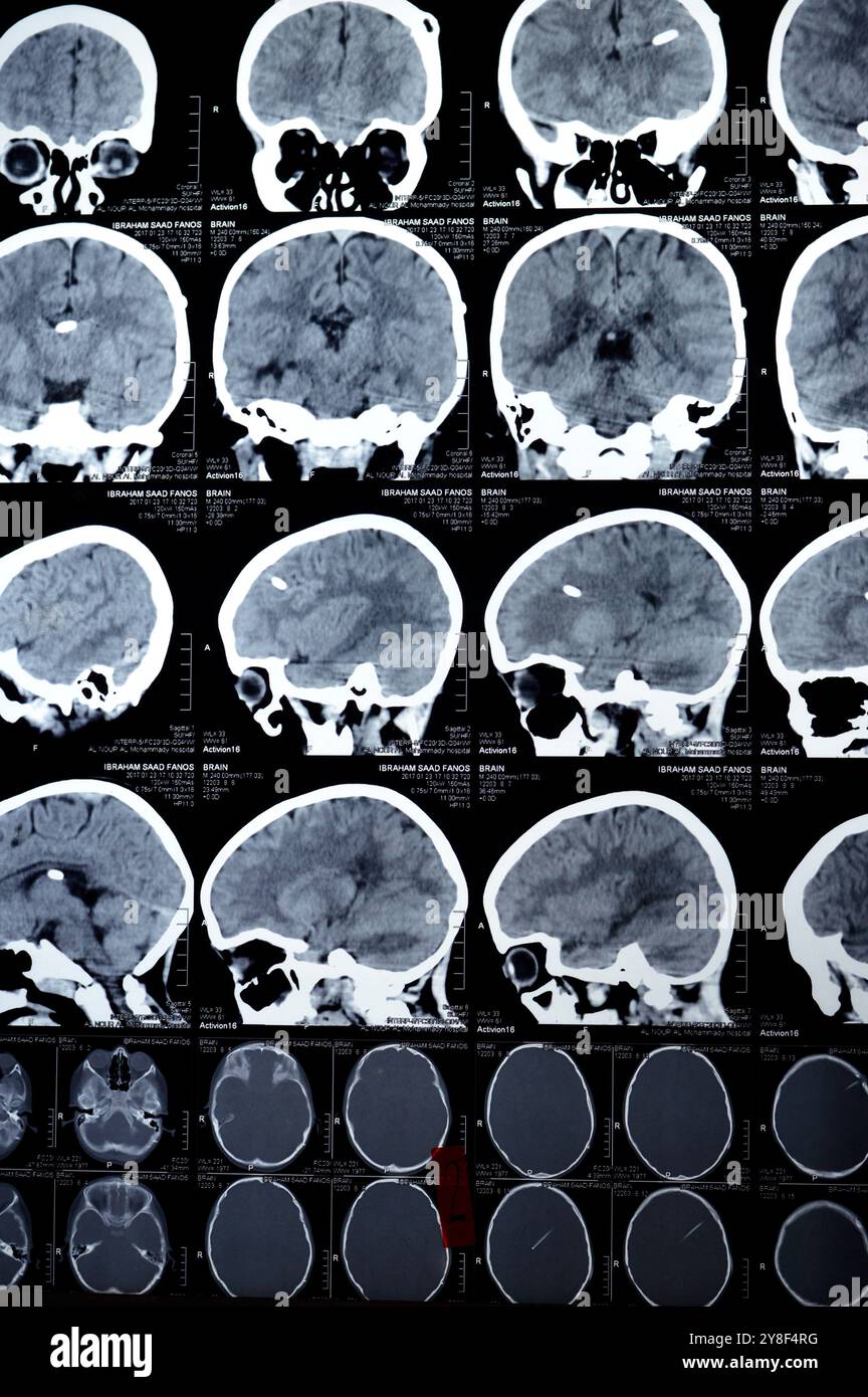 Cairo, Egypt, September 17 2024: Brain CT scan reveals left shunt tube ...