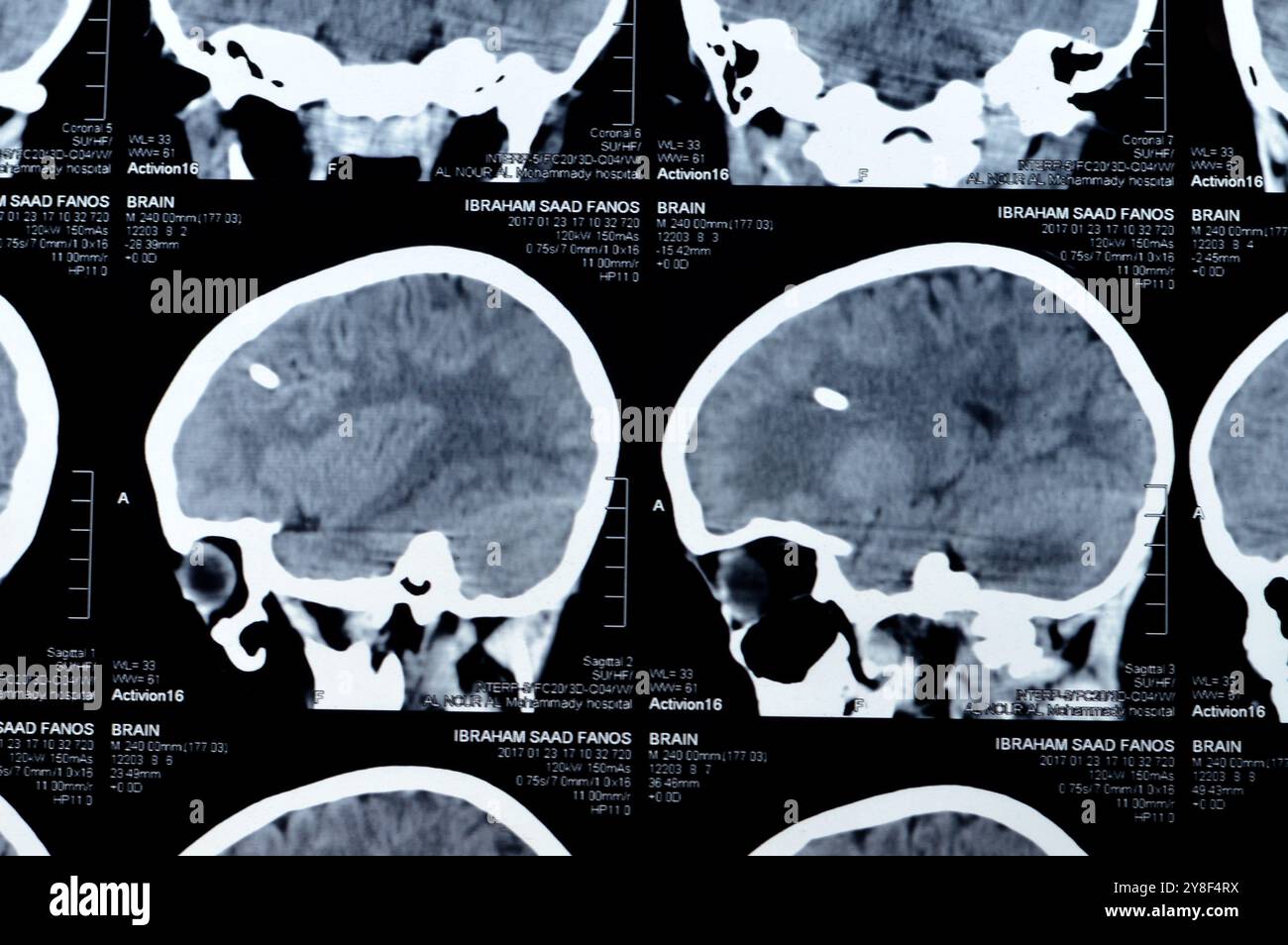 Cairo, Egypt, September 17 2024: Brain CT scan reveals left shunt tube ...