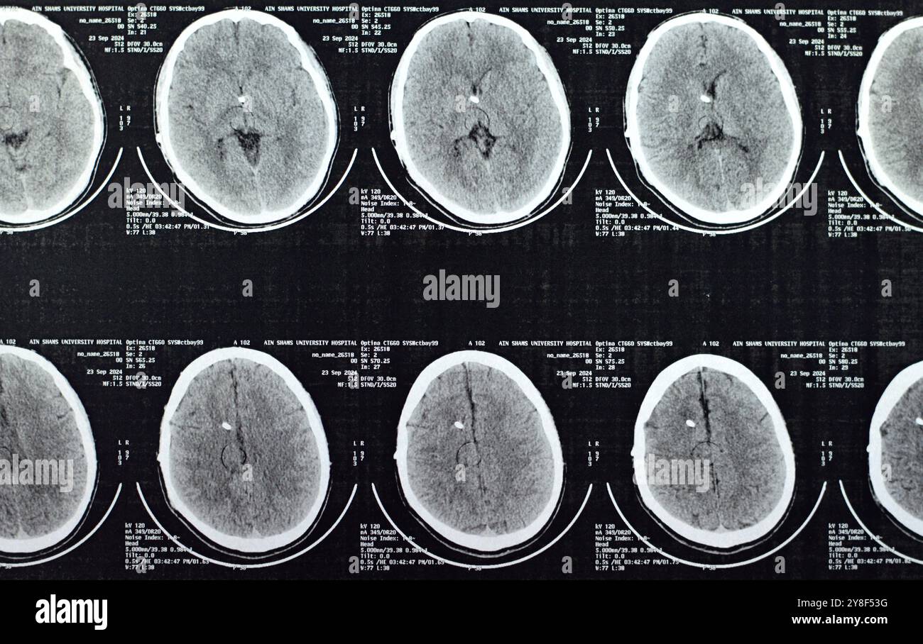 Cairo, Egypt, September 26 2024: A case of Hydrocephalus with a shunt ...