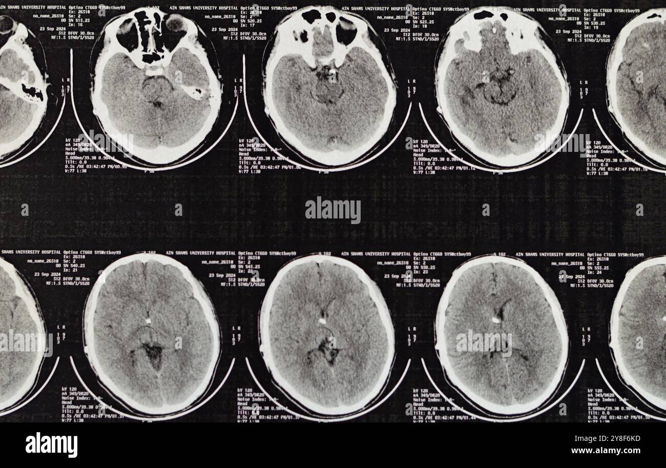 Cairo, Egypt, September 26 2024: A case of Hydrocephalus with a shunt ...