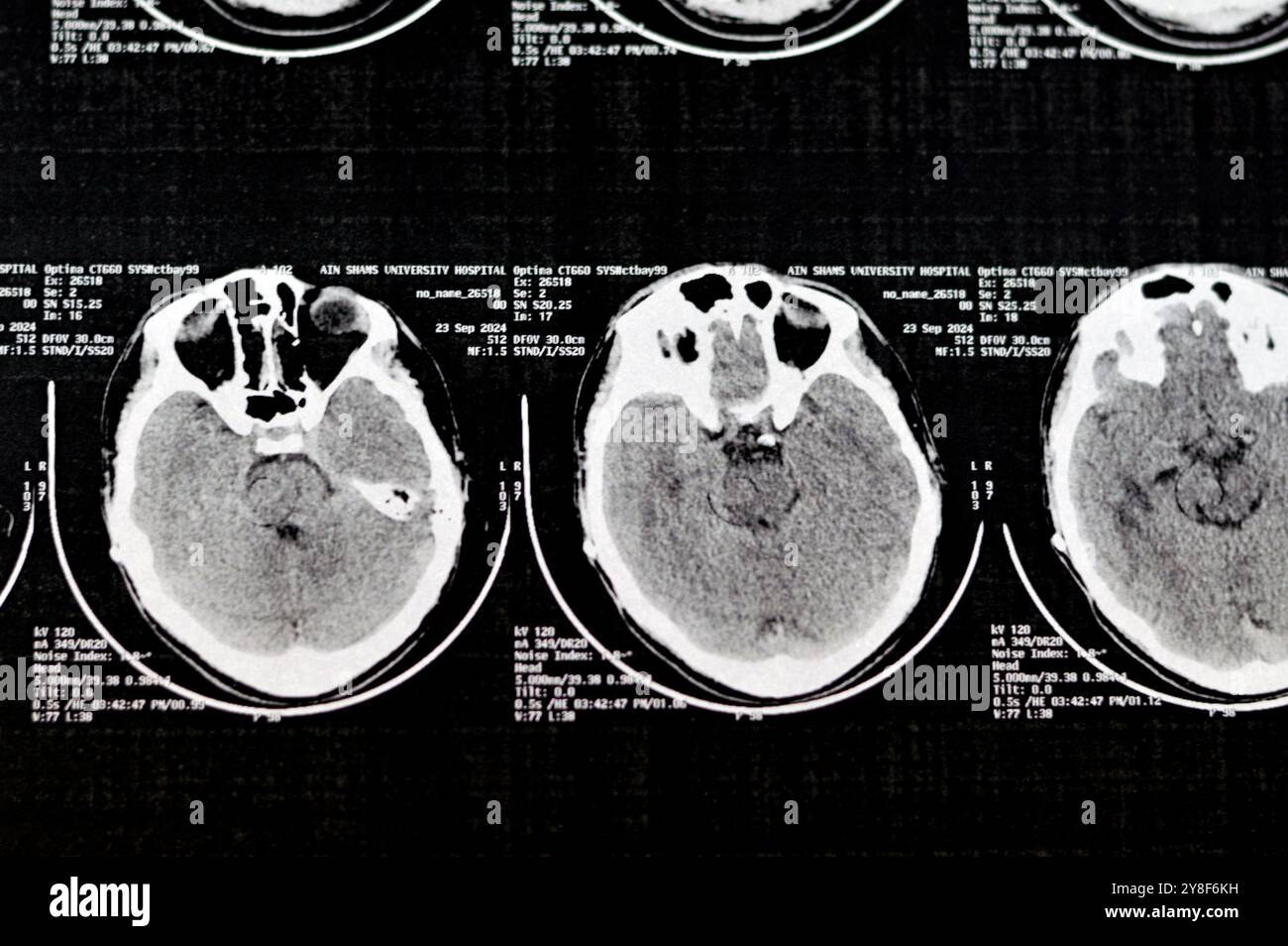 Cairo, Egypt, September 26 2024: A case of Hydrocephalus with a shunt ...