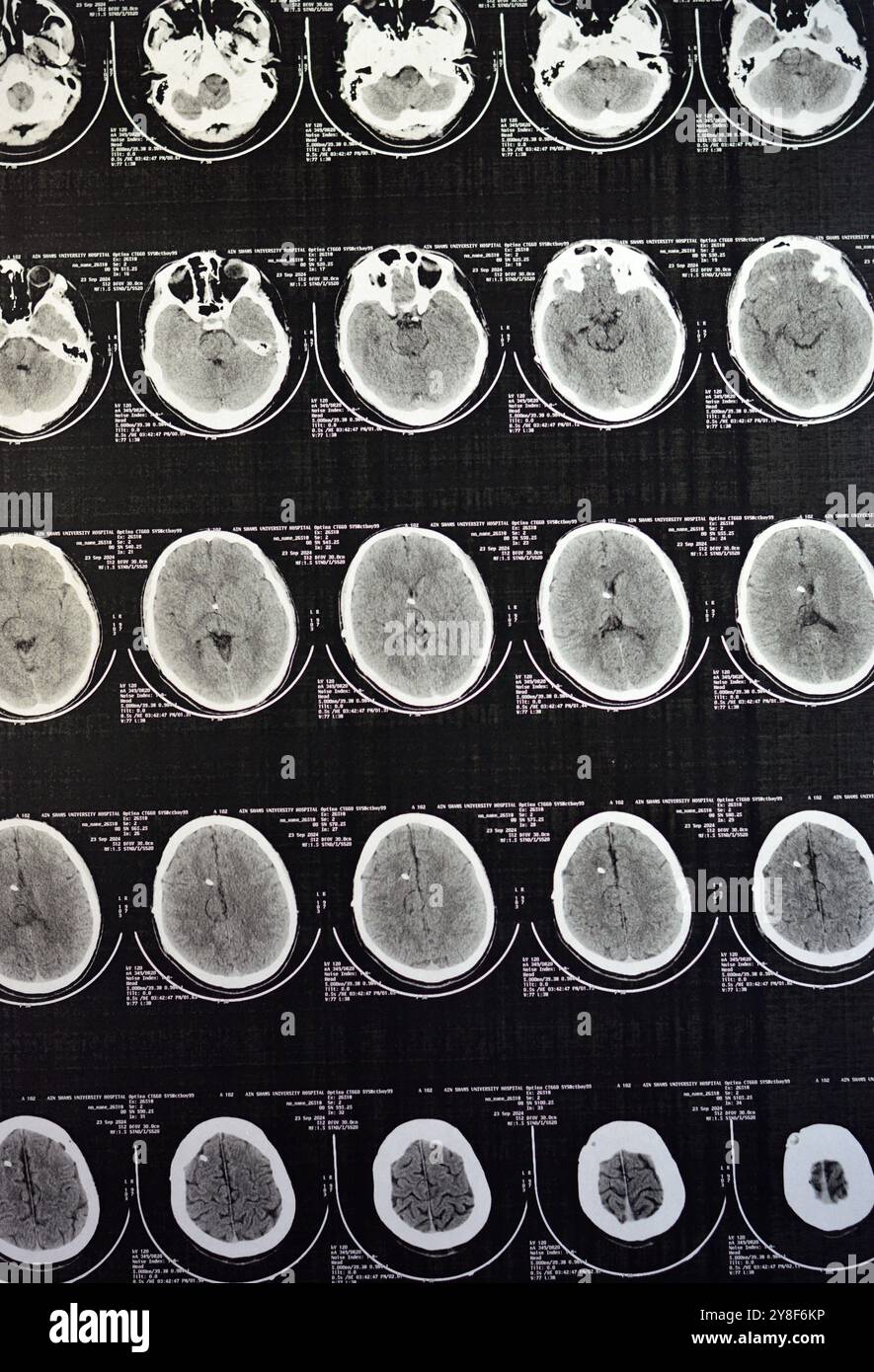 Cairo, Egypt, September 26 2024: A case of Hydrocephalus with a shunt ...