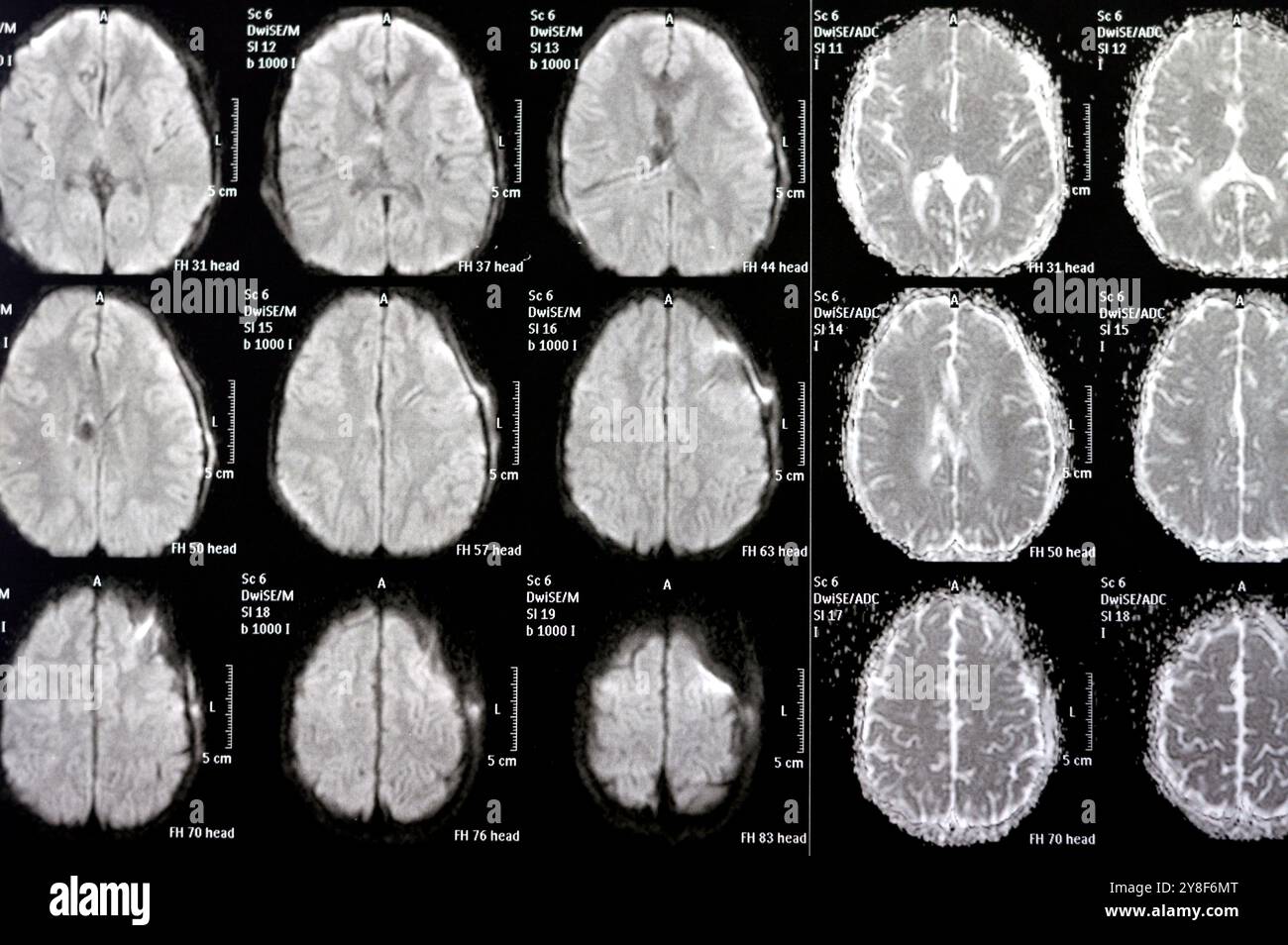 MRI of the brain reveals previous shunt operations for a hydrocephalus ...
