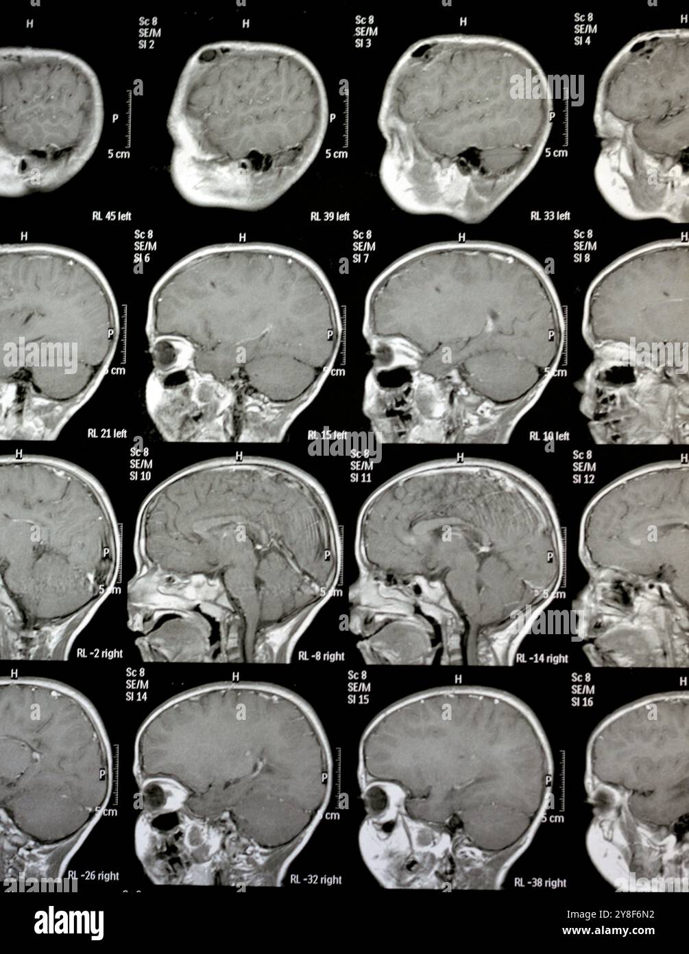 Intracranial pressure catheter hi-res stock photography and images - Alamy