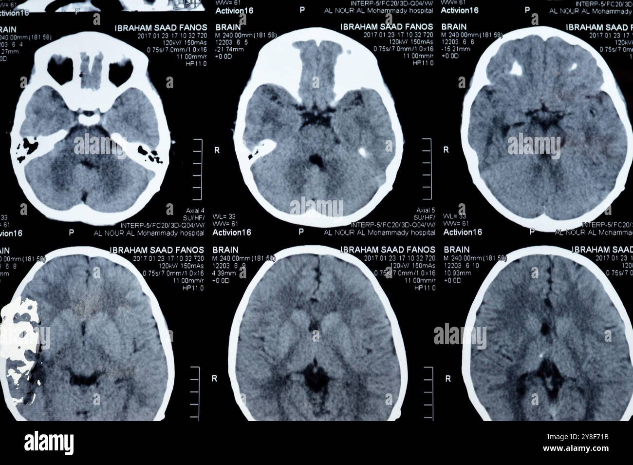 Cairo, Egypt, September 17 2024: Brain CT scan reveals left shunt tube ...