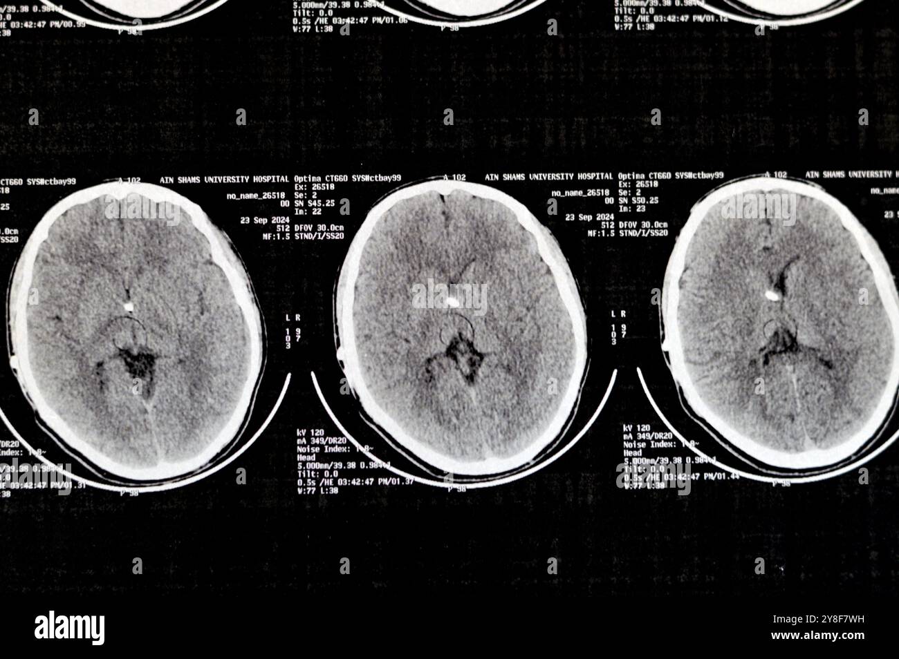 Cairo, Egypt, September 26 2024: A case of Hydrocephalus with a shunt ...