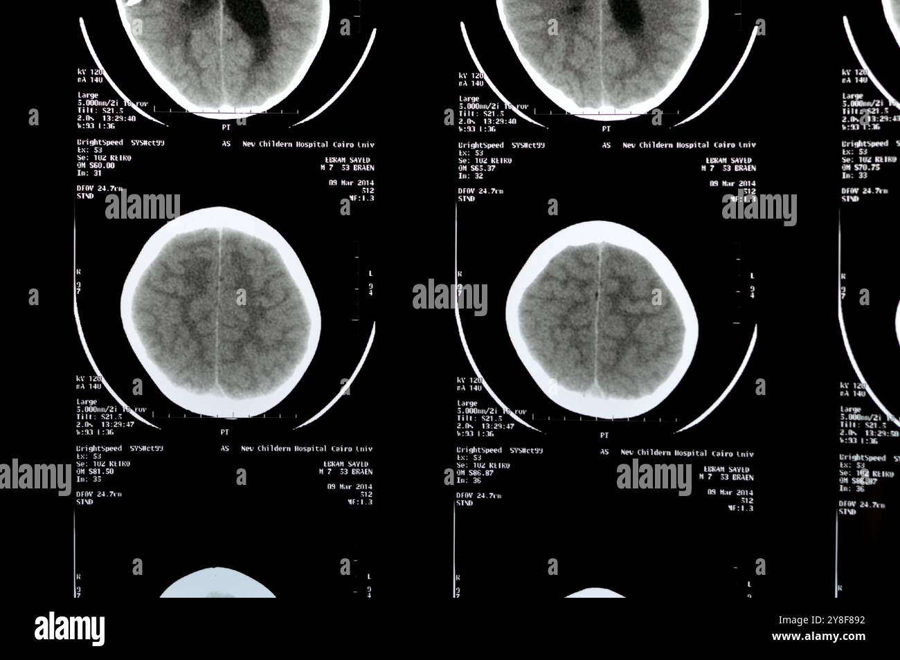 Cairo, Egypt, September 26 2024: post right sided shunt tube insertion ...