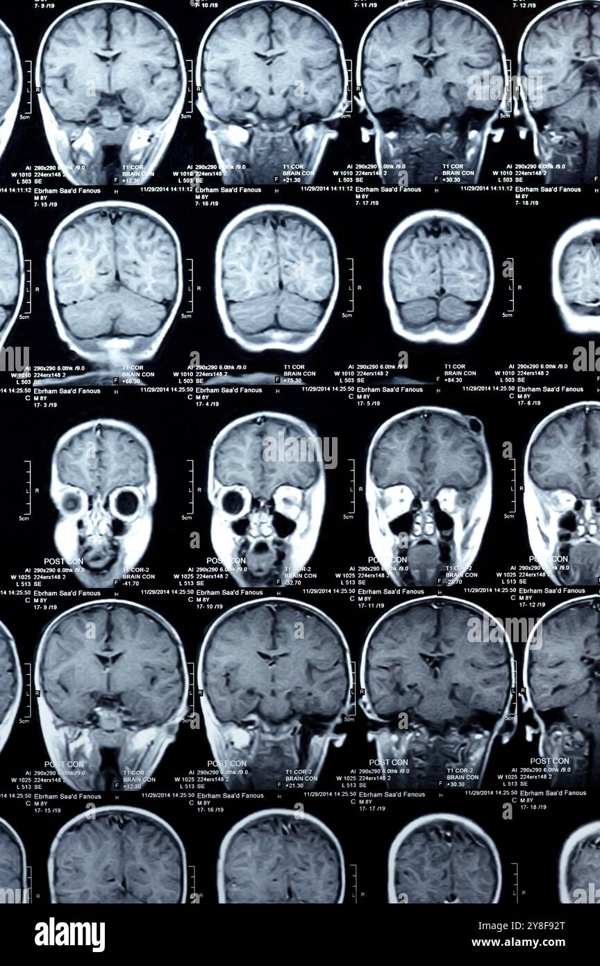 Cairo, Egypt, September 26 2024: MRI brain reveals functioning intra ...