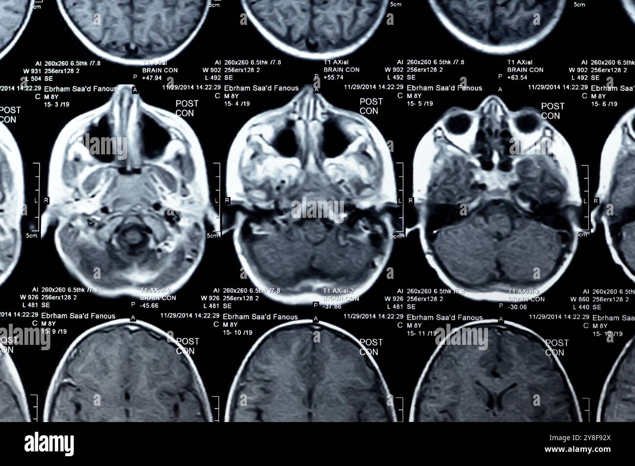 Cairo, Egypt, September 26 2024: MRI brain reveals functioning intra ...