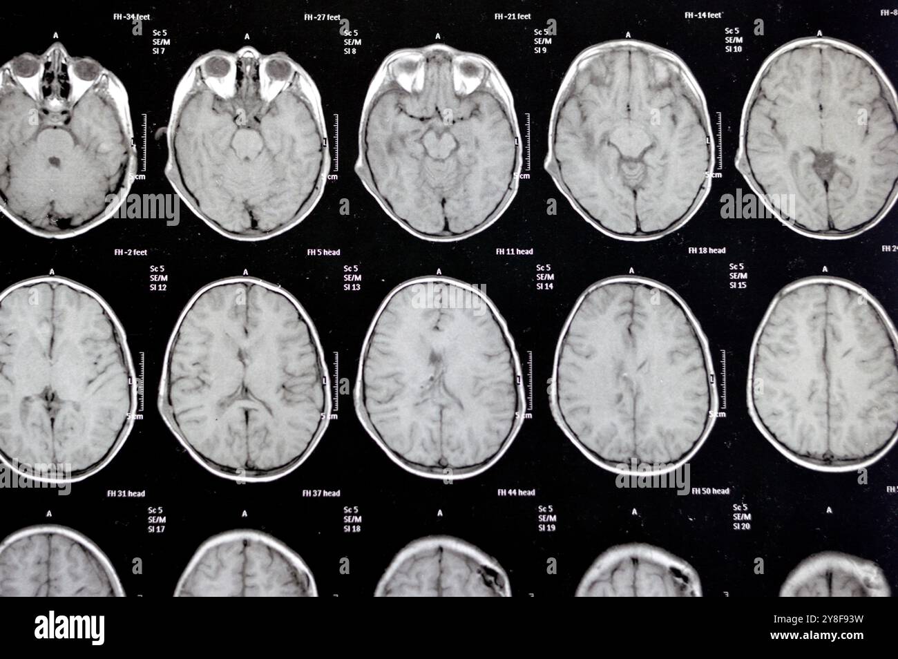 MRI of the brain reveals previous shunt operations for a hydrocephalus ...