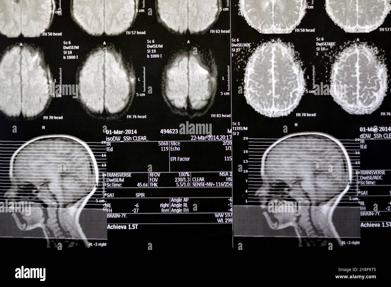 MRI of the brain reveals previous shunt operations for a hydrocephalus ...