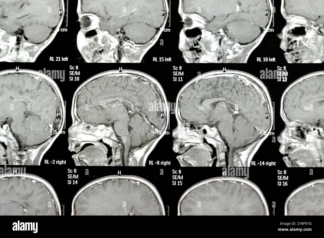 MRI of the brain reveals previous shunt operations for a hydrocephalus ...