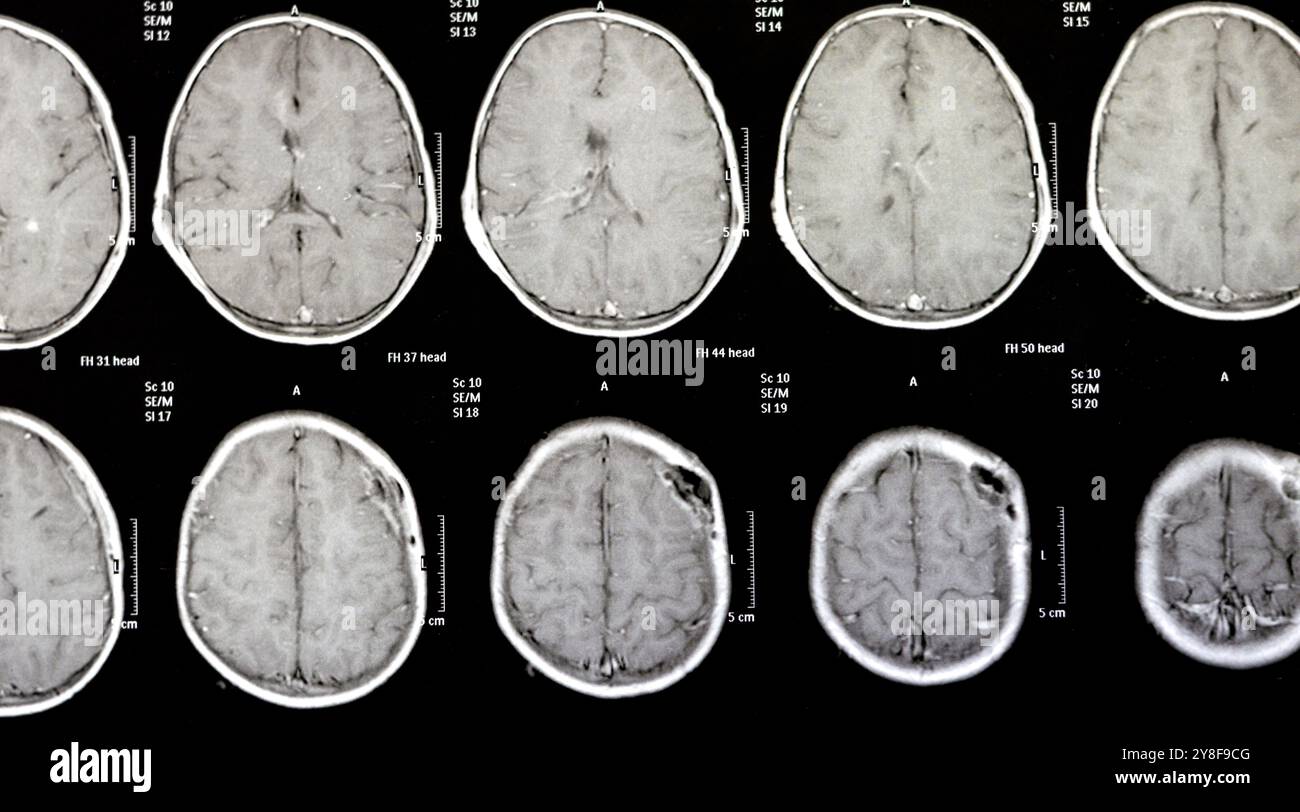 MRI of the brain reveals previous shunt operations for a hydrocephalus ...