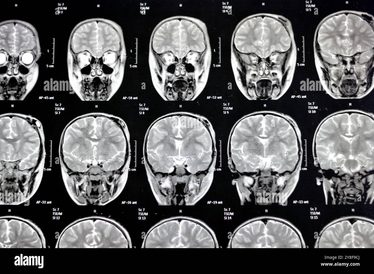 MRI of the brain reveals previous shunt operations for a hydrocephalus ...