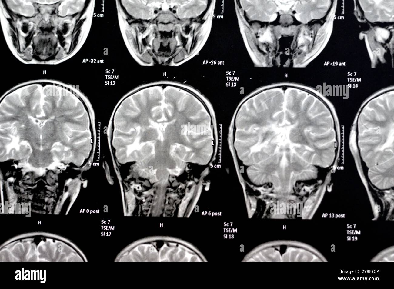 MRI of the brain reveals previous shunt operations for a hydrocephalus ...