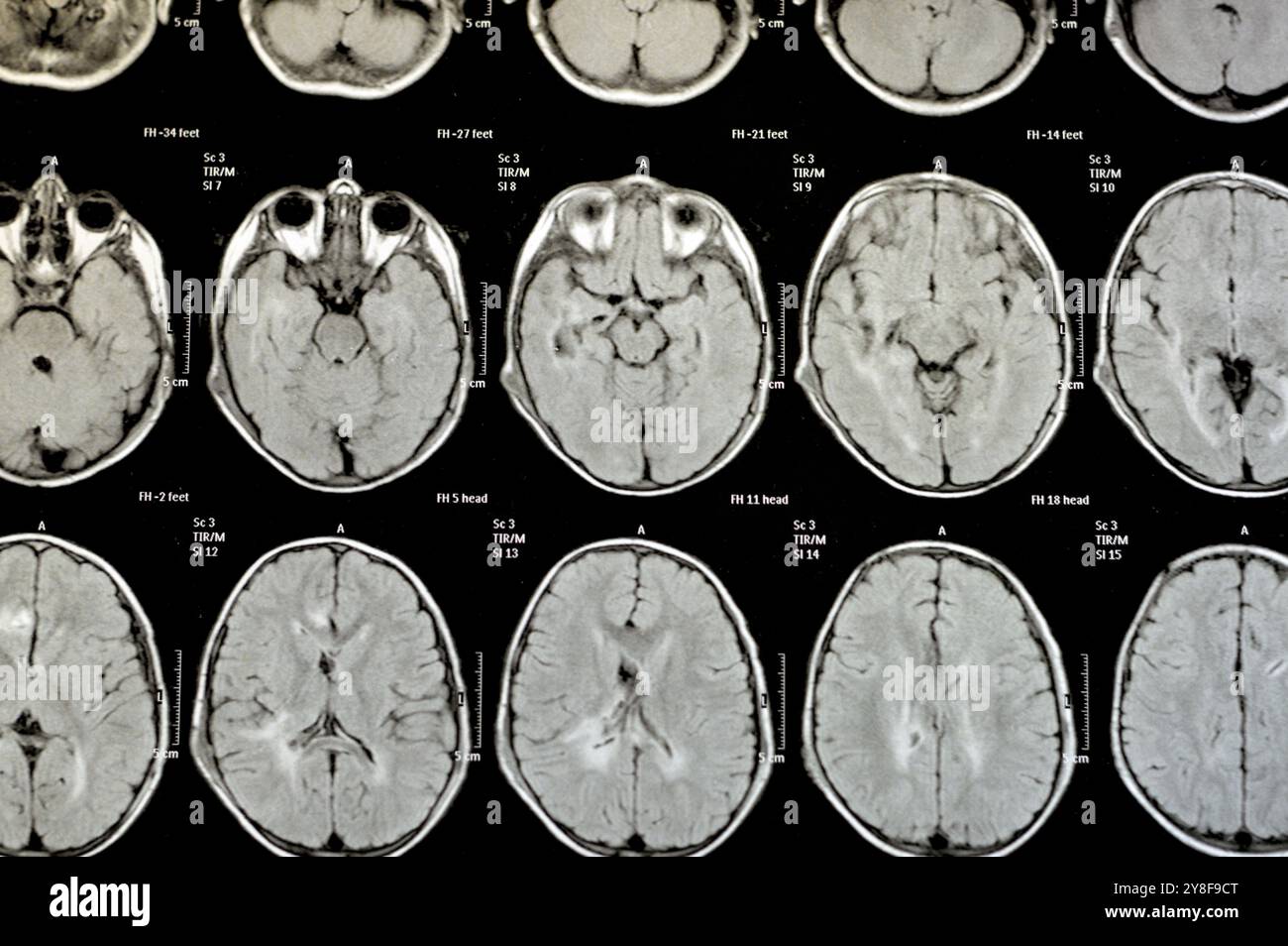 MRI of the brain reveals previous shunt operations for a hydrocephalus ...