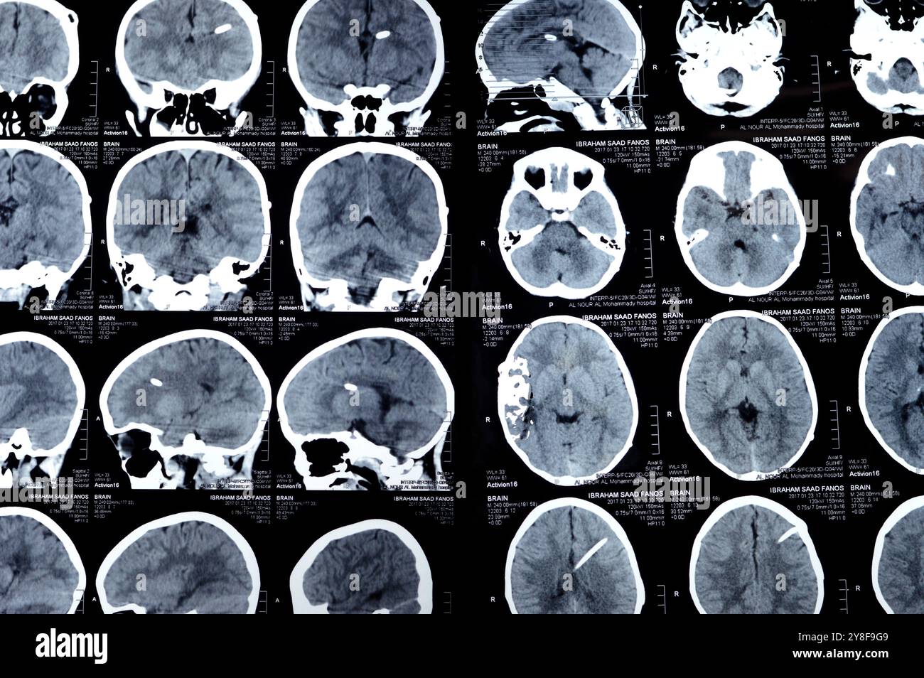 Cairo, Egypt, September 17 2024: Brain CT scan reveals left shunt tube ...