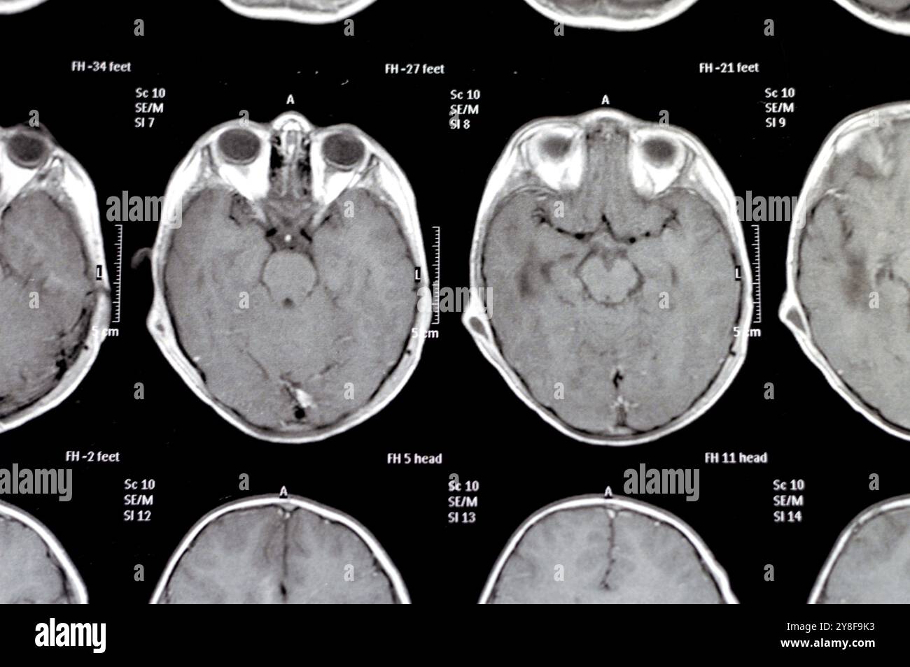 MRI of the brain reveals previous shunt operations for a hydrocephalus ...
