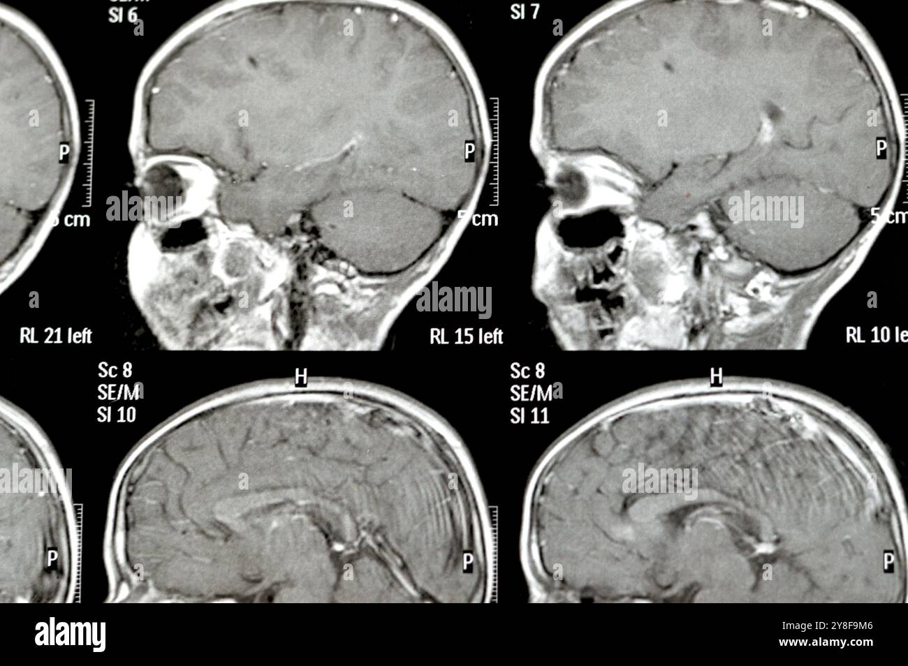 MRI of the brain reveals previous shunt operations for a hydrocephalus ...