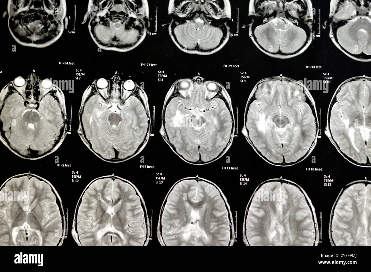 MRI of the brain reveals previous shunt operations for a hydrocephalus ...