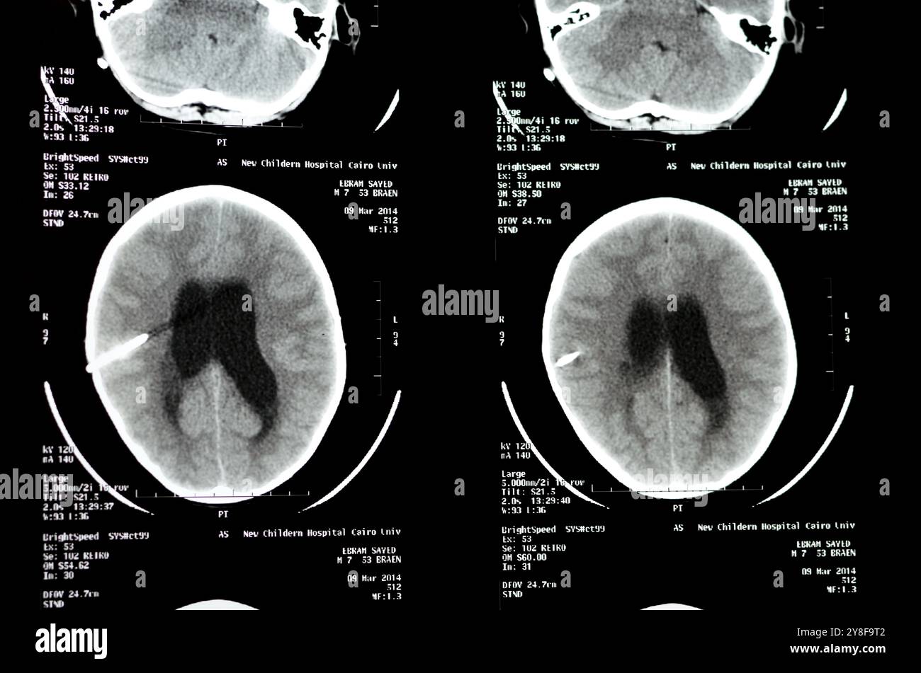 Cairo, Egypt, September 26 2024: post right sided shunt tube insertion ...