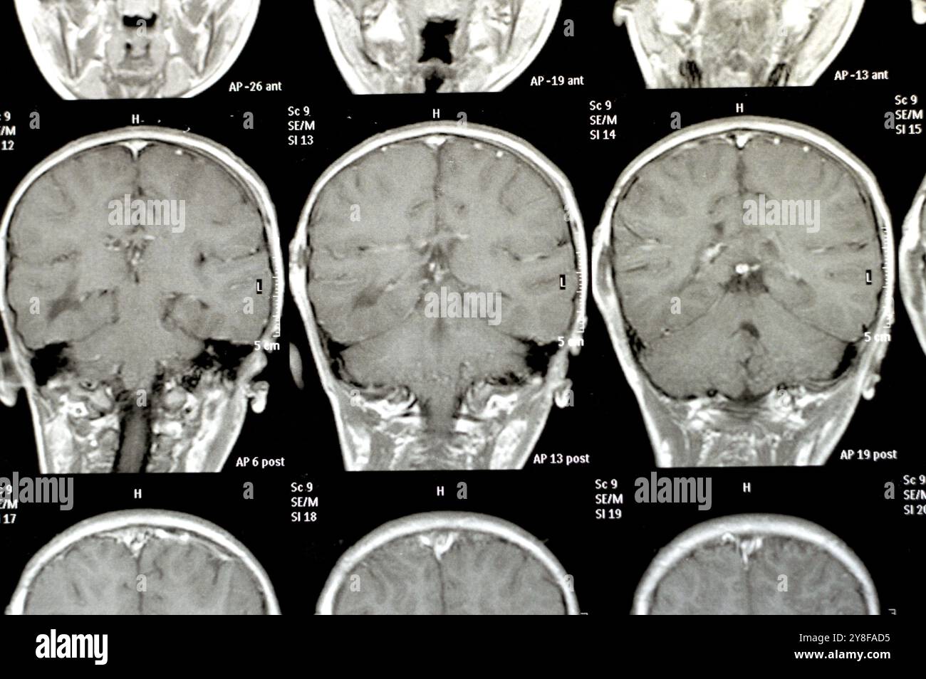 MRI of the brain reveals previous shunt operations for a hydrocephalus ...