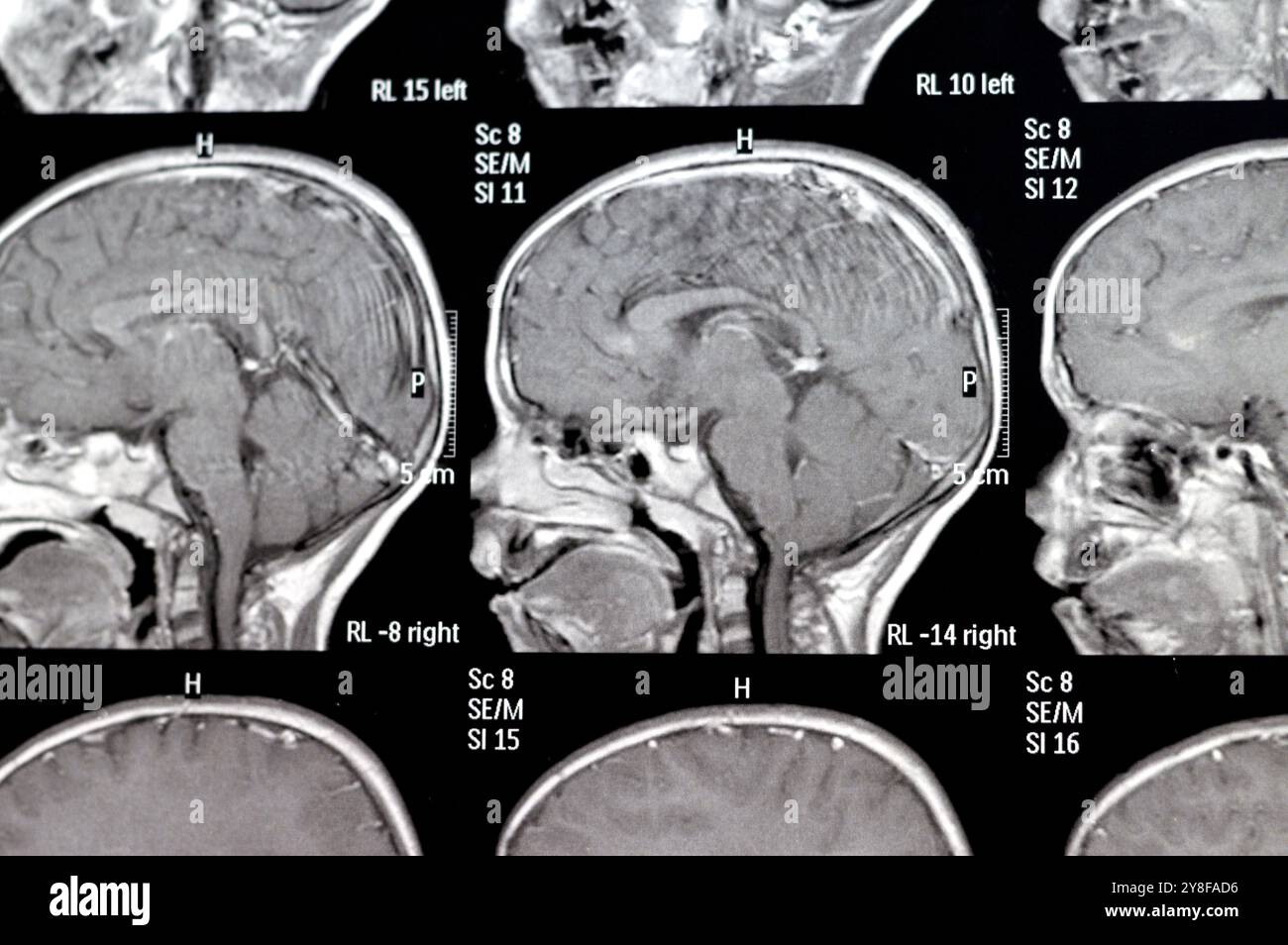 MRI of the brain reveals previous shunt operations for a hydrocephalus ...