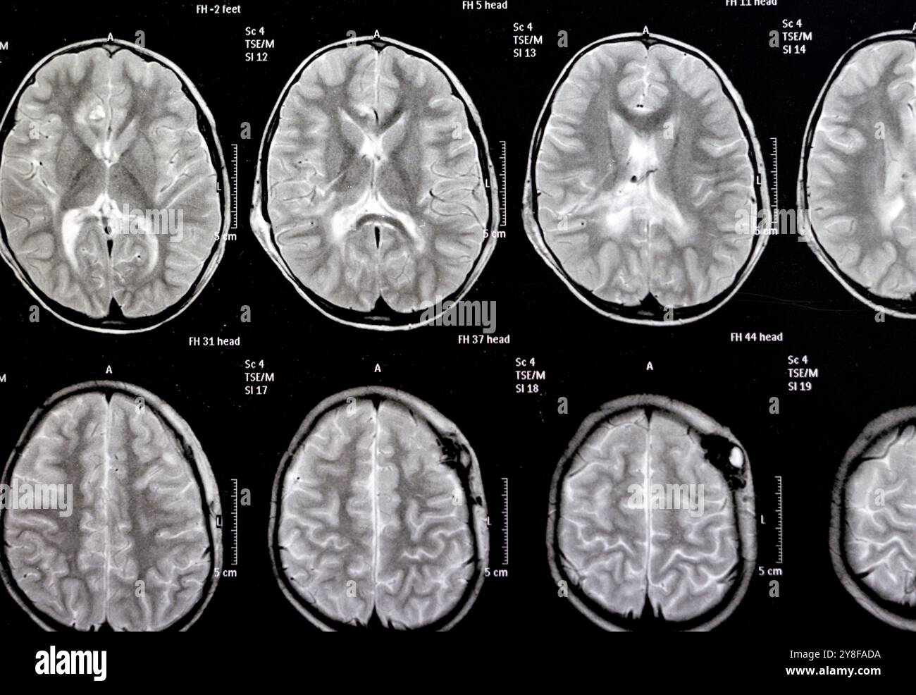 MRI of the brain reveals previous shunt operations for a hydrocephalus ...