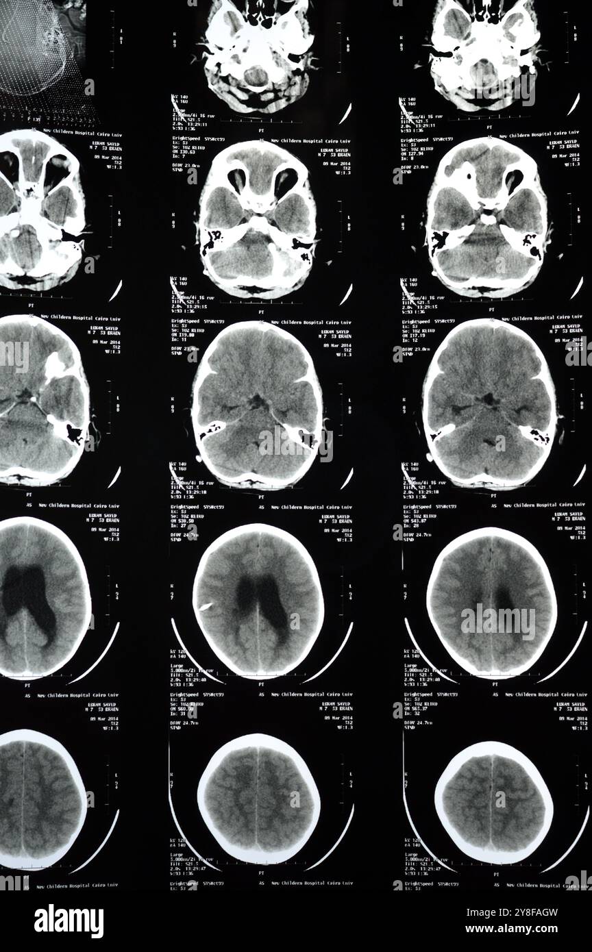 Cairo, Egypt, September 26 2024: post right sided shunt tube insertion ...