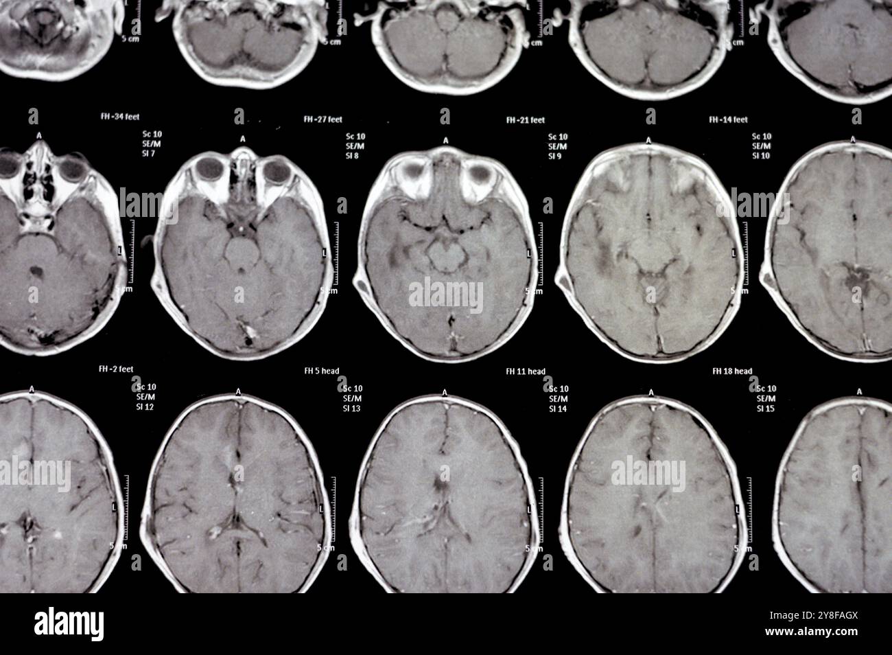 MRI of the brain reveals previous shunt operations for a hydrocephalus ...