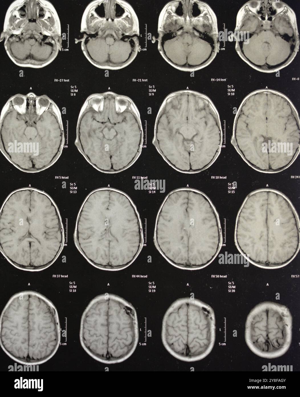 MRI of the brain reveals previous shunt operations for a hydrocephalus ...
