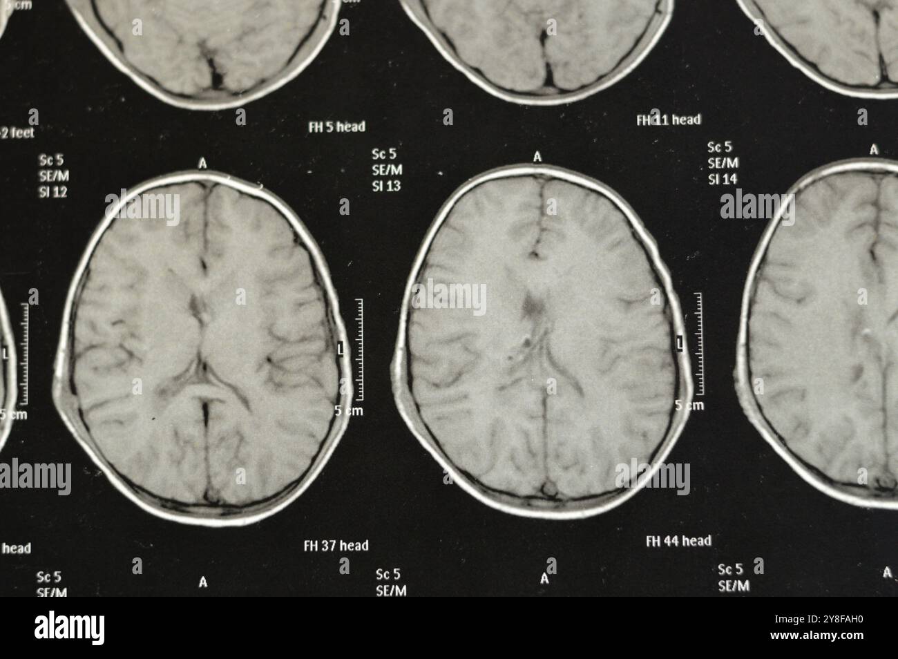MRI of the brain reveals previous shunt operations for a hydrocephalus ...