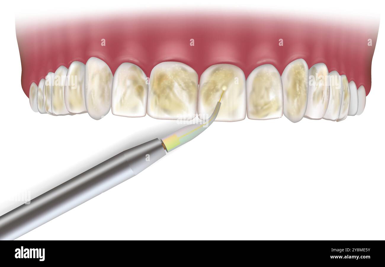 Laser Removal of Dental Calculus. Dental laser. Laser Therapy Stock ...