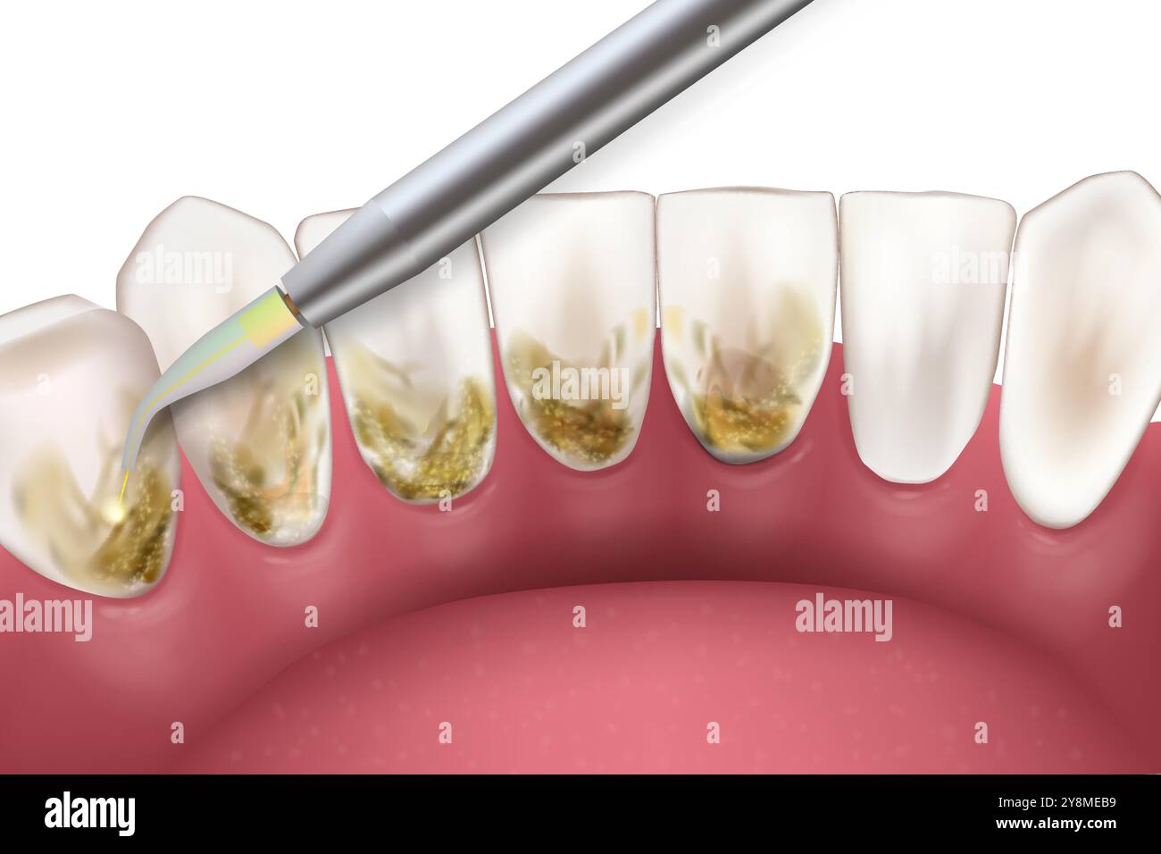 Laser Removal of Dental Calculus. Dental laser. Laser Therapy Stock ...