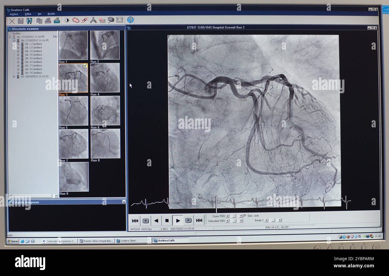 Angioplasty, Stenting in coronary arteries, Hemodynamic, Operating room ...