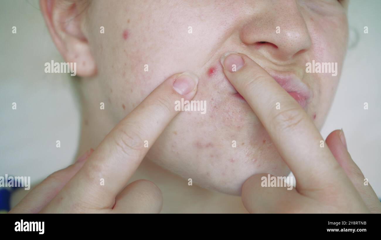 Close up of skin problems, unhealthy skin with acne and pimples. Porous ...