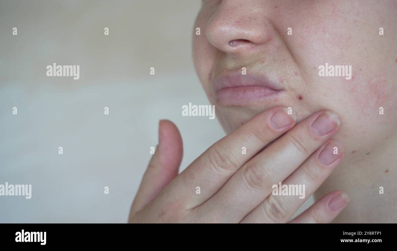 Close up of skin problems, unhealthy skin with acne and pimples. Porous ...