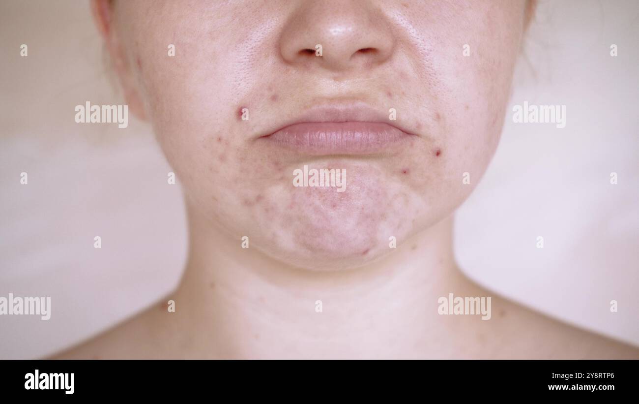 Close up of skin problems, unhealthy skin with acne and pimples. Porous ...