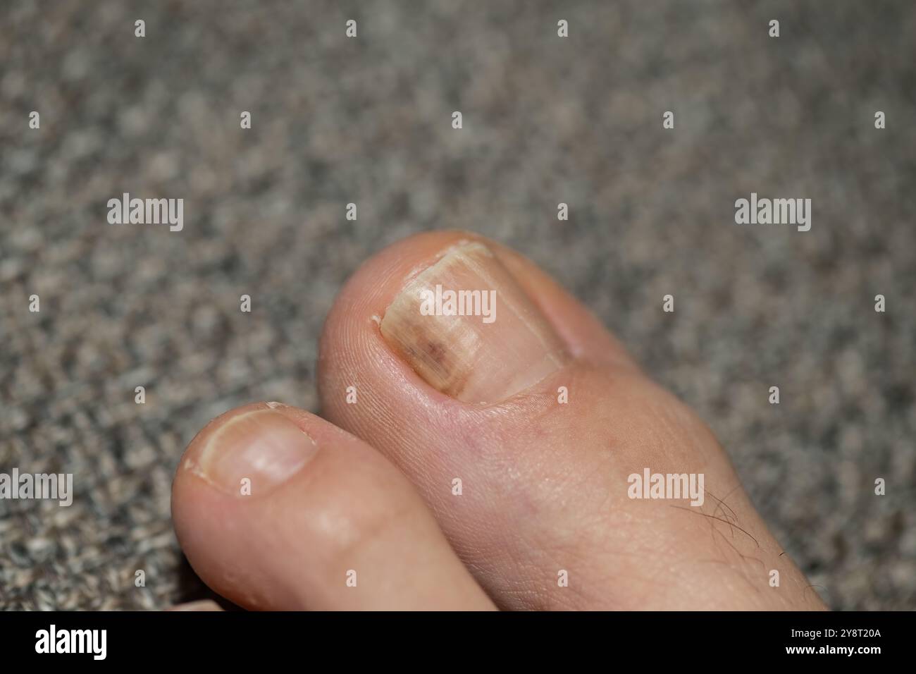 Person feet nail disease hi-res stock photography and images - Alamy