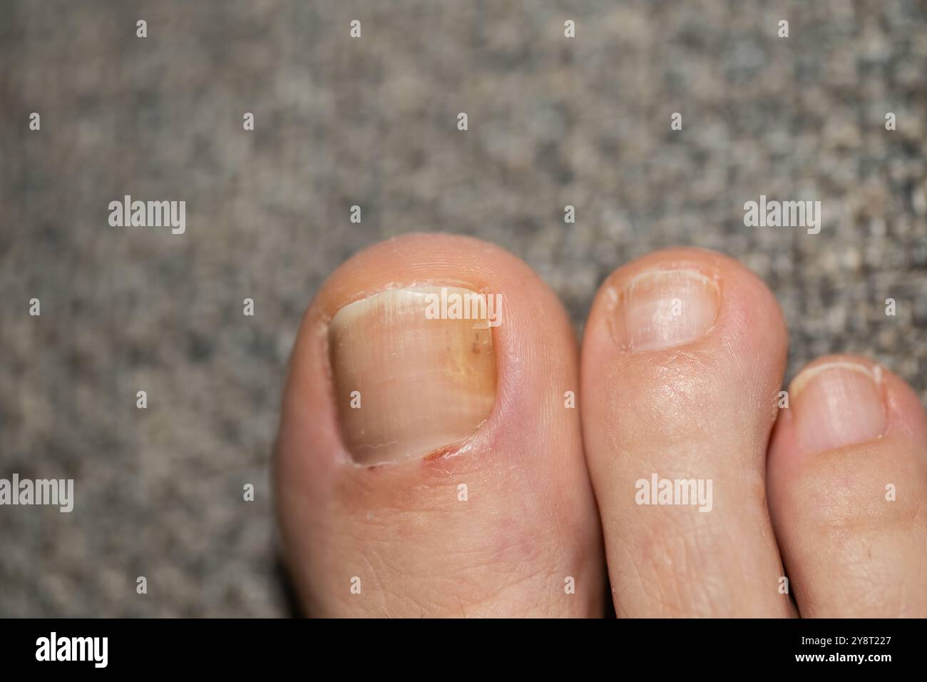 Fungal disease of the woman's toenail Stock Photo - Alamy